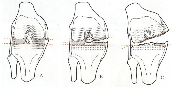 무릎 통증 무릎 해부학 무릎의 구조와 기능1 전방십자인대 후방십자인대 내측측부인대 외측측부인대 무릎뼈 고준영